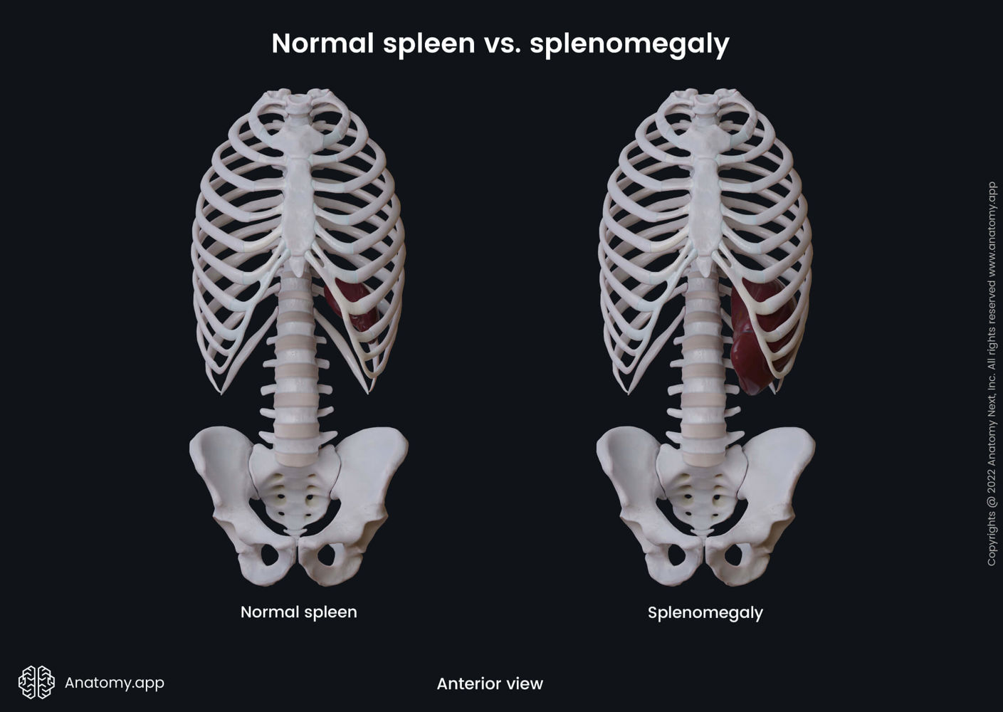 Normal spleen vs. splenomegaly | Anatomy.app