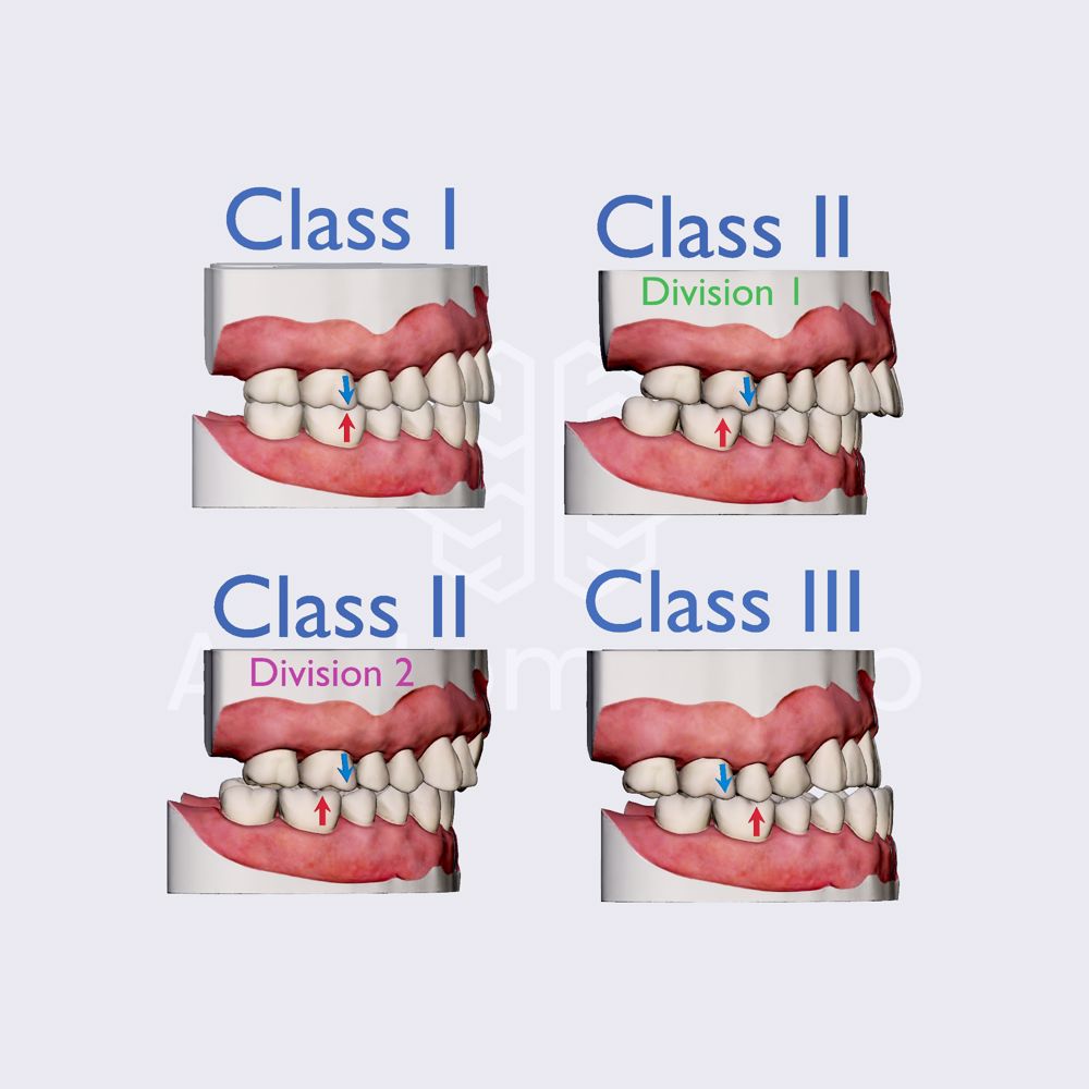 Angle s Classification Anatomy app Angle s Classification Anatomy app